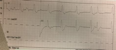 Dr Smiths Ecg Blog Syncope Several Times Complete Heart Block And