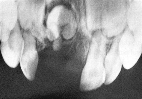 4 Tooth Development And Disturbances In Number And Shape Of Teeth