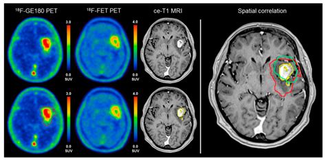 Epilepsy Brain Vs Normal Brain