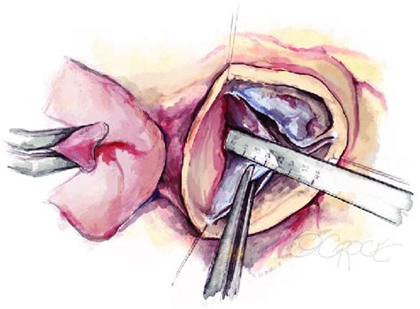 Aortic Root Exposure And Gh Measurement Under Cardioplegic Arrest The