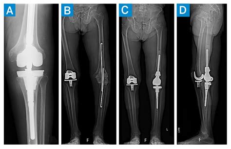 Distal Femoral Replacement