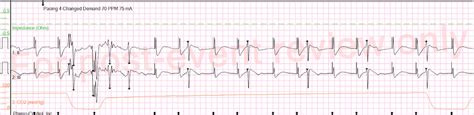 Transcutaneous Pacing Part 2