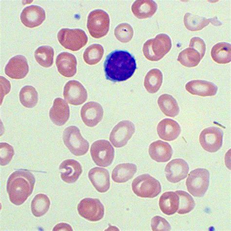 Red Blood Cell Size Blood Film Medschool
