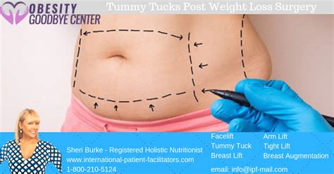 Tummy Tucks Post Weight Loss Surgery Bariatric Edition
