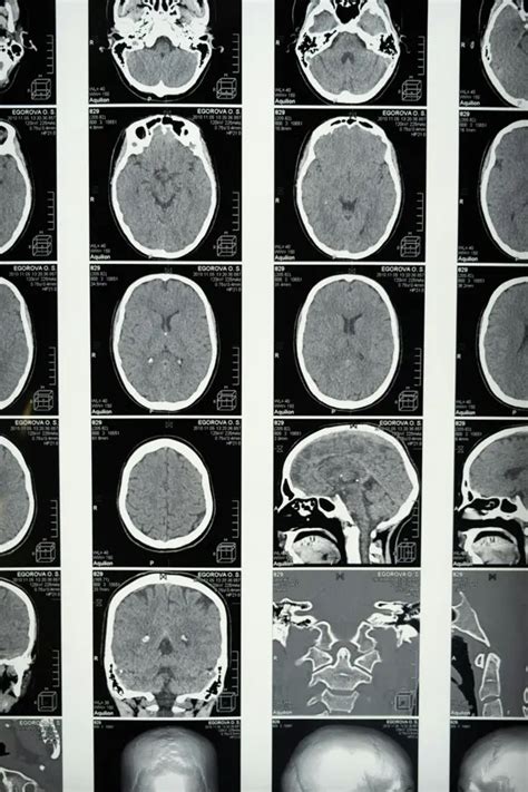 revolutionizing brain tumour detection by using deep learning algorithm