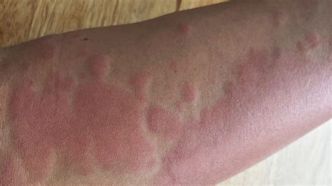 Understanding Histamine Intolerance In Immunity Cbh Energetics