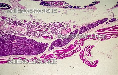 Parathyroid Gland Hyperplasia Light M Stock Image Science Source