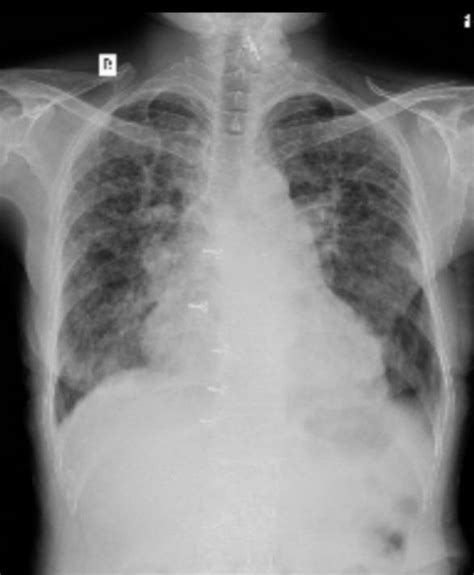 On 1 2 22 Chest Pa View Suggest Of Reticular Opacities In Bilateral Download Scientific Diagram