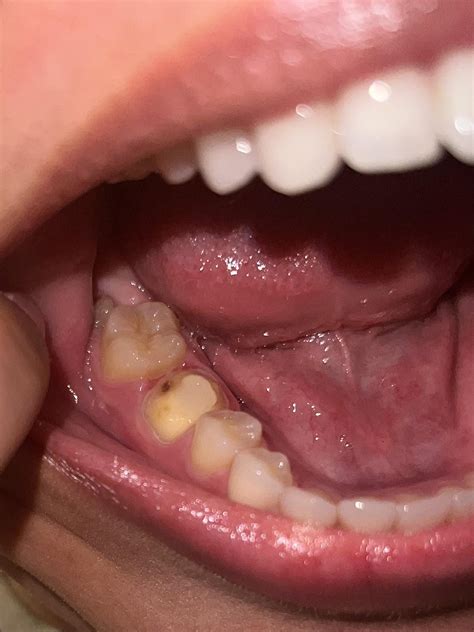 Crown Prep Sus Raskdentists