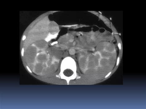 Solid Renal Masses Imaging Pptx
