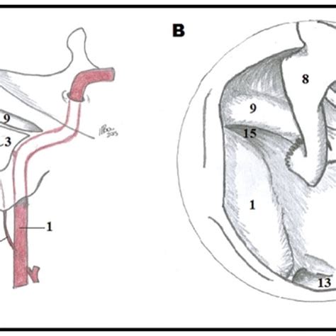 Pdf The Surgical Challenge Of Carotid Artery And Fallopian Canal