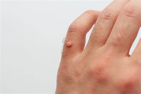 Teledermatology Practical For Cutaneous Wart Treatment Dermatology