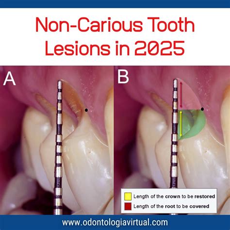 Non Carious Tooth Lesions In 2025 An Evidence Based Playbook For