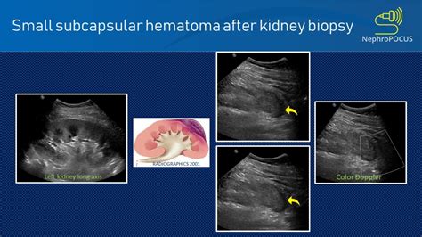 Post Biopsy Bleeding Nephropocus