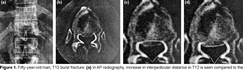 Figure 1 From The Relationship Between The Ratio Of Interpedicular