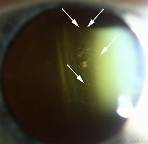 Posterior Vitreous Detachment Weiss Ring