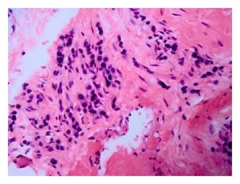Hande 20x Ct Guided Psoas Muscle Biopsy Showing Tumor Cells In The Download Scientific Diagram