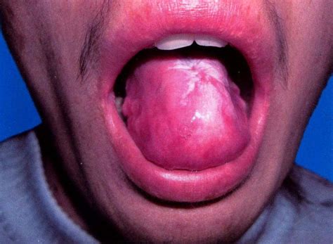 显性营养不良型大疱表皮松解症 皮肤病性病图谱 医学