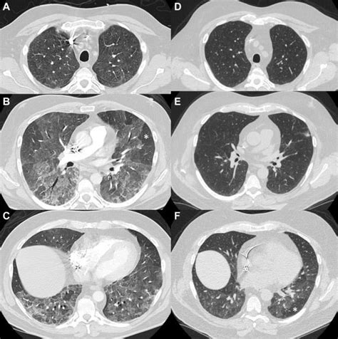 Ild Diagnosis And Management Are Tied To Identification Of Inciting Environmental Antigens
