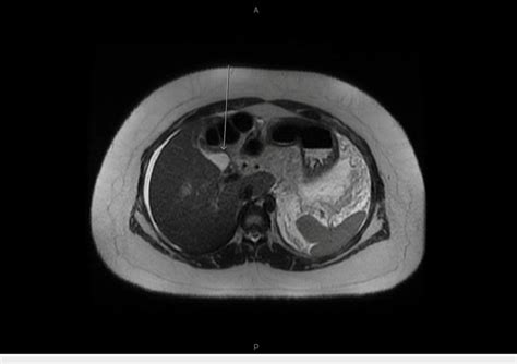 Heavily T2 Weighed Mrcp Image 1 Mrcp Magnetic Resonance Download Scientific Diagram