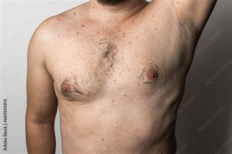 Naked Man With Red Pimples On His Chest Acne Skin Disease Dermatology Problem Stock Photo