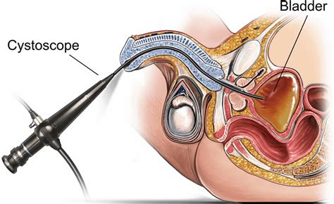 Cystoscopy Bph Surgery Melbourne Melbourne Vic