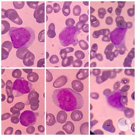Leukemia Cutis In Acute Myeloid Leukemia 2