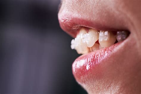 Orthodontic Jaw Repositioning For Oral Health Ahava Orthodontics
