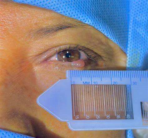 Carcinoma Basocelular Nodular Oculoplastia