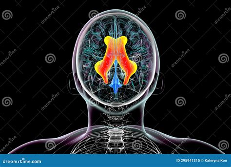 Enlarged Lateral Ventricles Of The Brain 3d Illustration