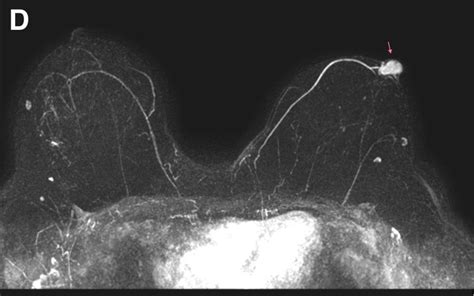 Large Retroareolar Solitary Intraductal Papilloma Of The Breast