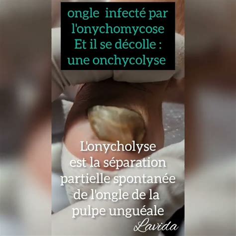 Onychomycose Onycholyse Youtube