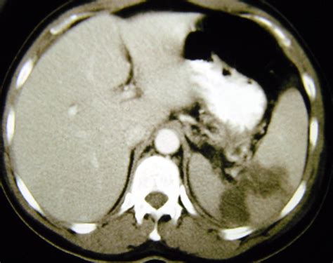 Abscess Surgery Photos