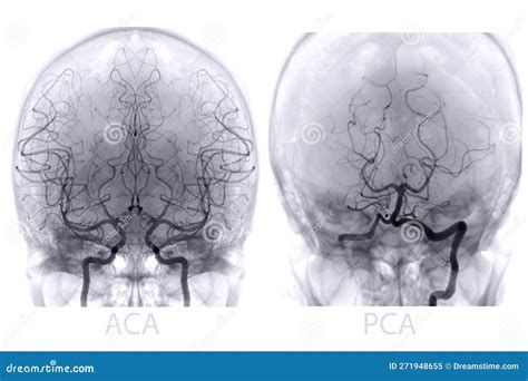 Cerebral Angiography Image From Fluoroscopy In Intervention Radiology