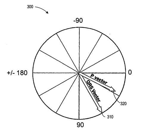 Arrhythmia Discrimination Using Electrocardiograms Sensed From Multiple Implanted Electrodes