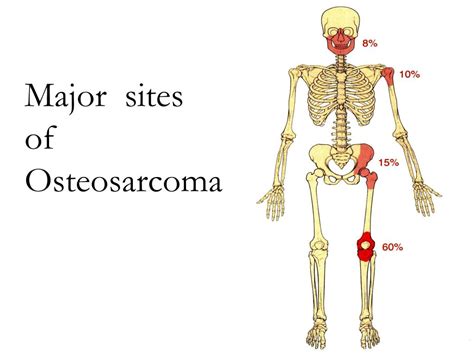 Ppt Bone Tumors Powerpoint Presentation Free Download Id 3335429