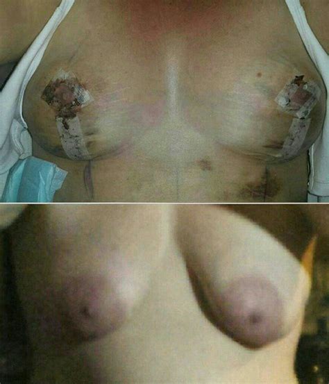 Nicoles Story Breast Lift Tummy Tuck