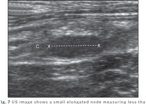 [pdf] Post Thyroidectomy Neck Ultrasonography In Patients With Thyroid
