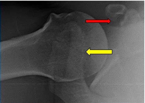 Case Presentation For Arthroscopic Internal Fixation Of Coracoid