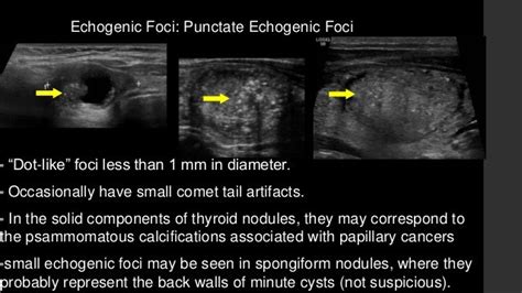 Thyroid Imaging Reporting And Data System
