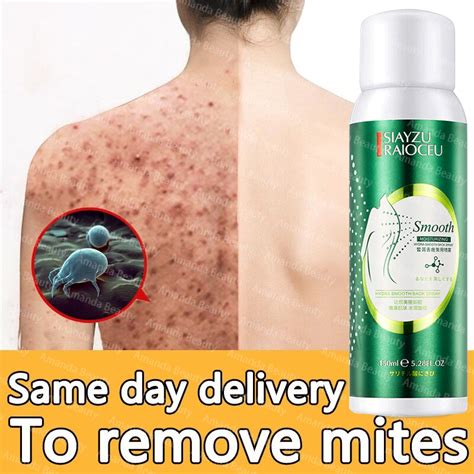 Back Acne Treatment Spray Antibacterial Anti Acne Gentle Exfoliating