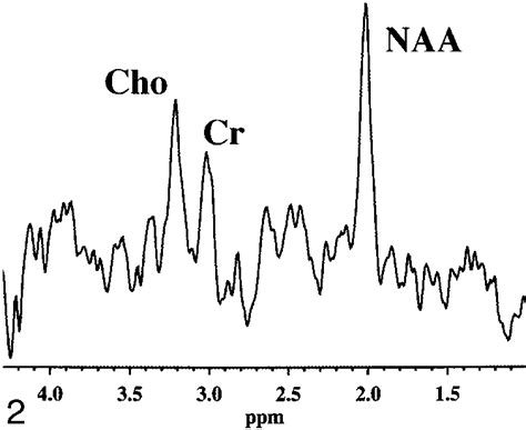Proton Mr Spectrum Obtained From Normal Splenium The Naacr Ratio Is