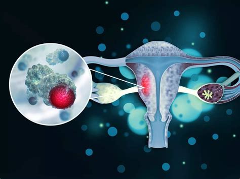 Cervical Cancer Know All About The Sexually Transmitted Infection Sti