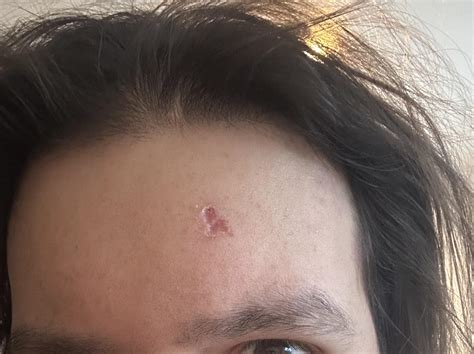 Scab Is Off Huge Crater Scar Visible Anything I Can Do Now To Reduce Scarring Improve