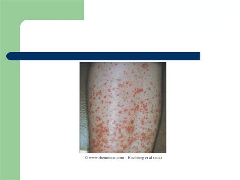 Signs And Symptoms In Rheumatology Ppt