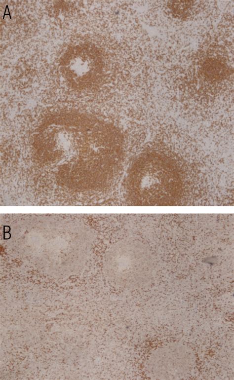 Microscopically The Lesion Showed Proliferation Of Lymphoid Follicles Download Scientific