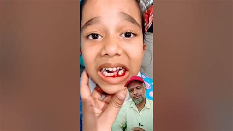 Chocolate Khate Huye Ek Bacche Ka Tooth Gir Gya 😅 Toothfall