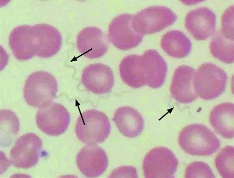 Wright Stain Of Peripheral Blood Demonstrating Extracellular