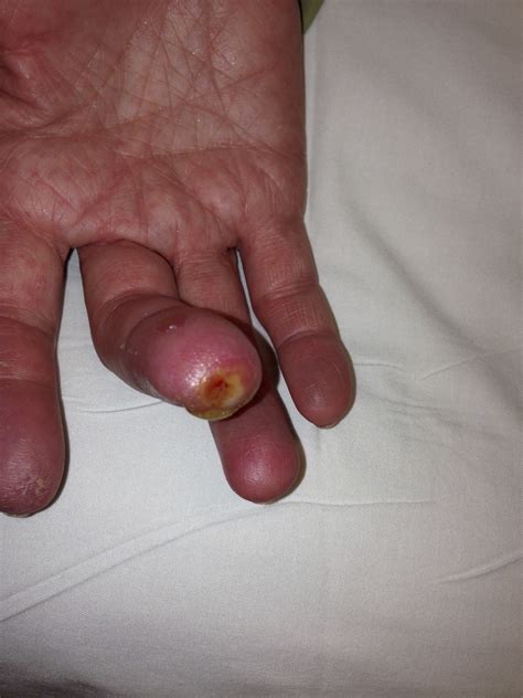 Ischemic Ulcer Rheumexam Atlas