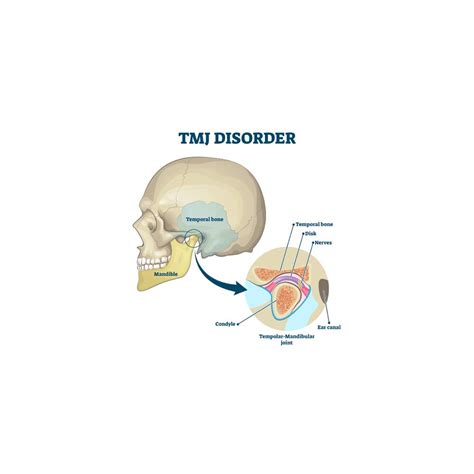 Tmj Disorder Shreveport La Shreveport Dental Solutions